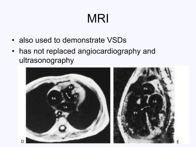 Imaging of Ventricular Septal Defects.ppt