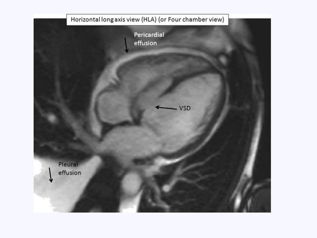 Imaging of Ventricular Septal Defects.ppt