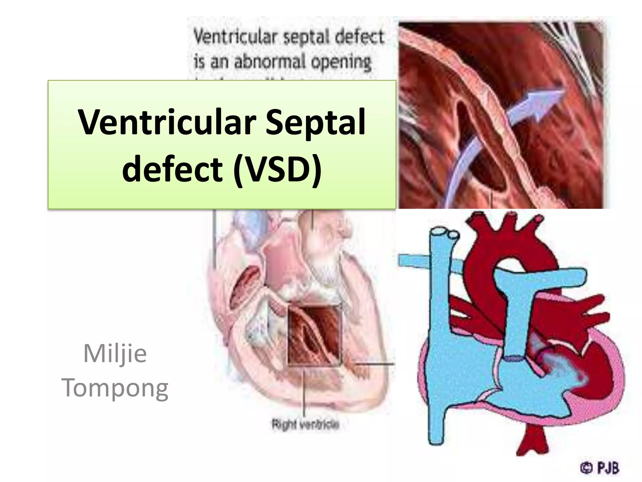 Ventricular septal defect (vsd) | PPTX