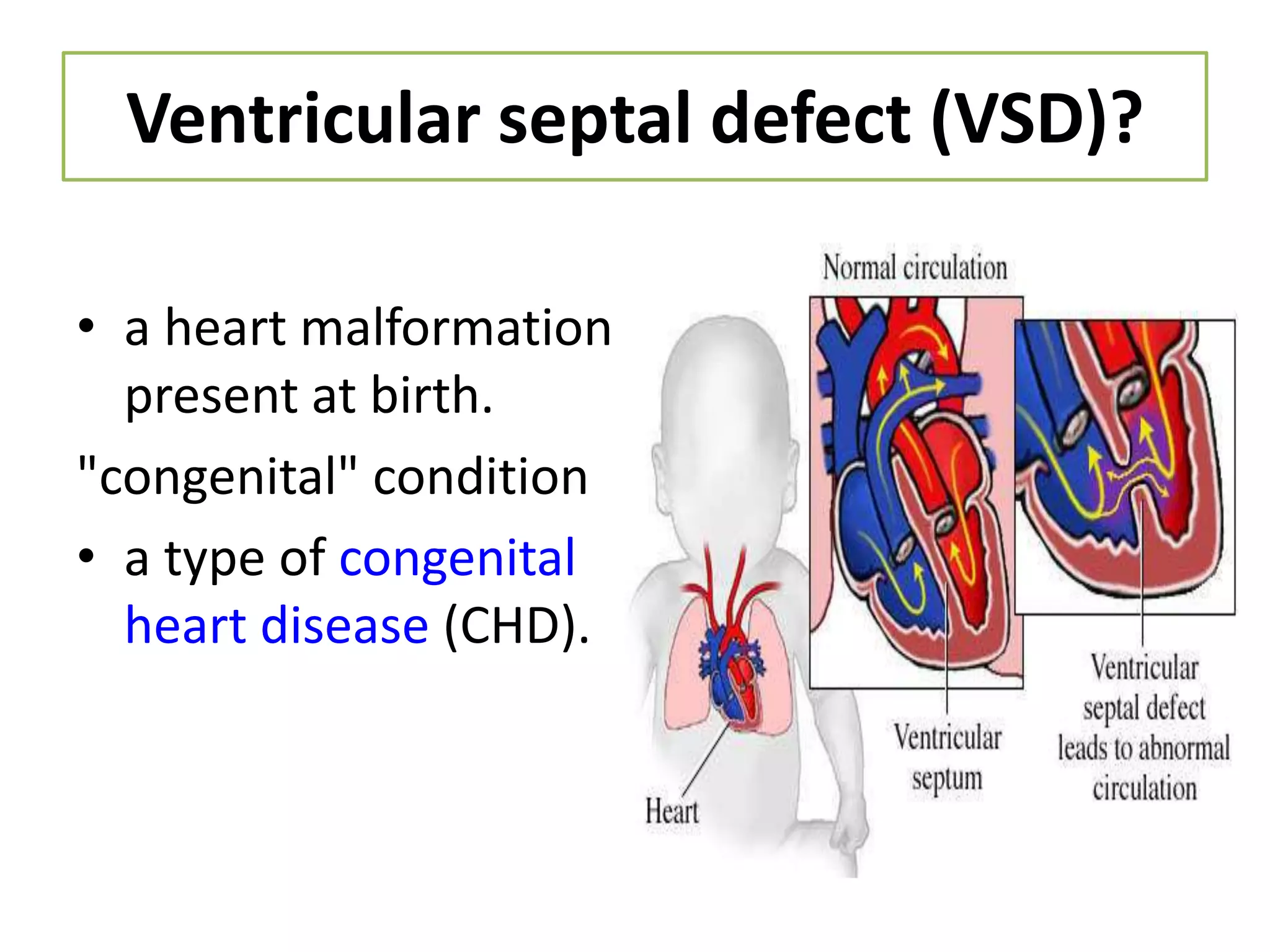 Ventricular septal defect (vsd) | PPTX