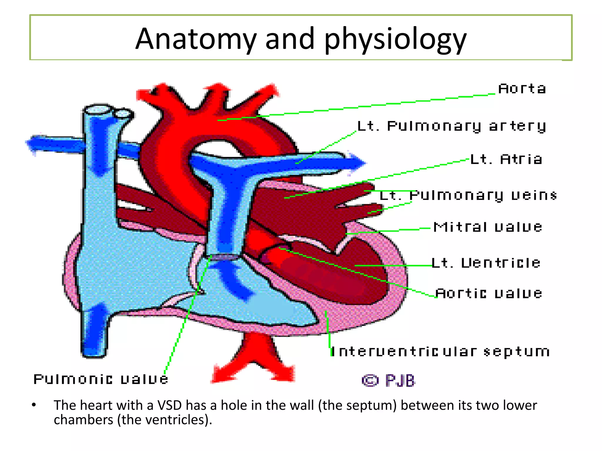 Ventricular septal defect (vsd) | PPTX