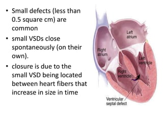 Ventricular septal defect (vsd) | PPTX