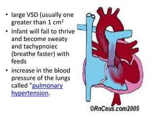 Ventricular septal defect (vsd) | PPTX