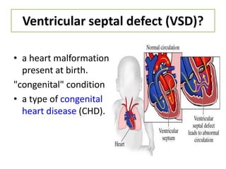 Ventricular septal defect (vsd) | PPTX