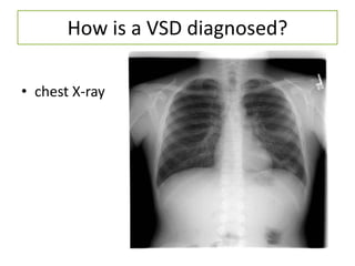 Ventricular septal defect (vsd) | PPTX
