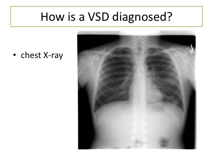 Ventricular septal defect (vsd)