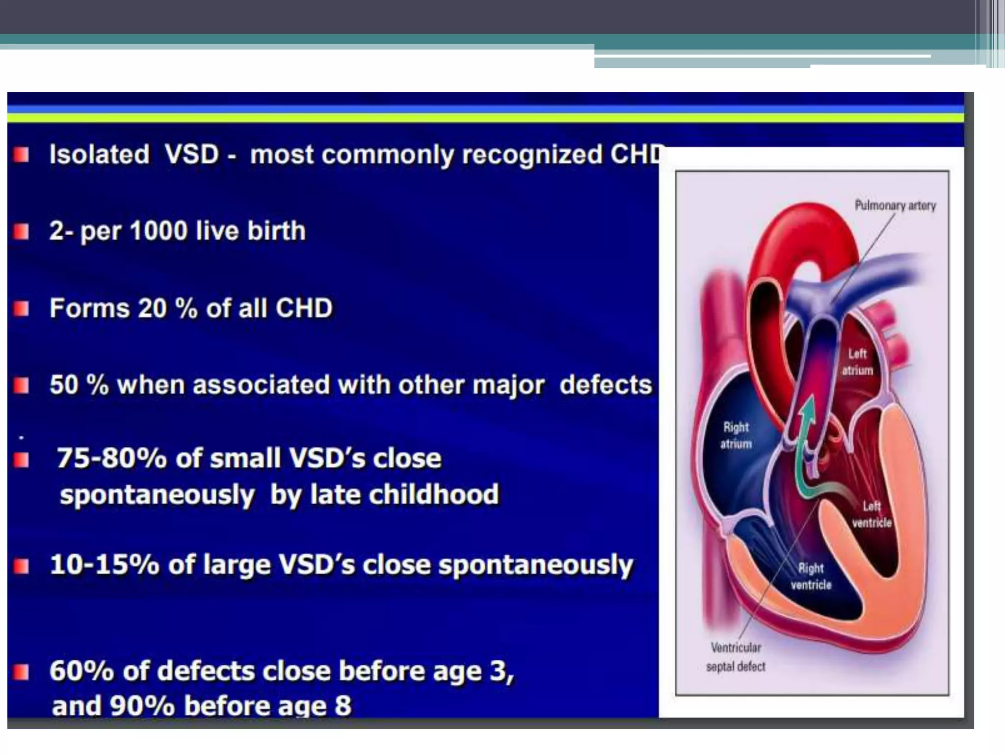 Ventricular septal defect (vsd) | PPTX