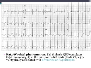 Ventricular Septal Defect Ecg