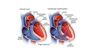 Ventricular septal defect (vsd) | PPT