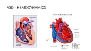 Ventricular septal defect (vsd) | PPT