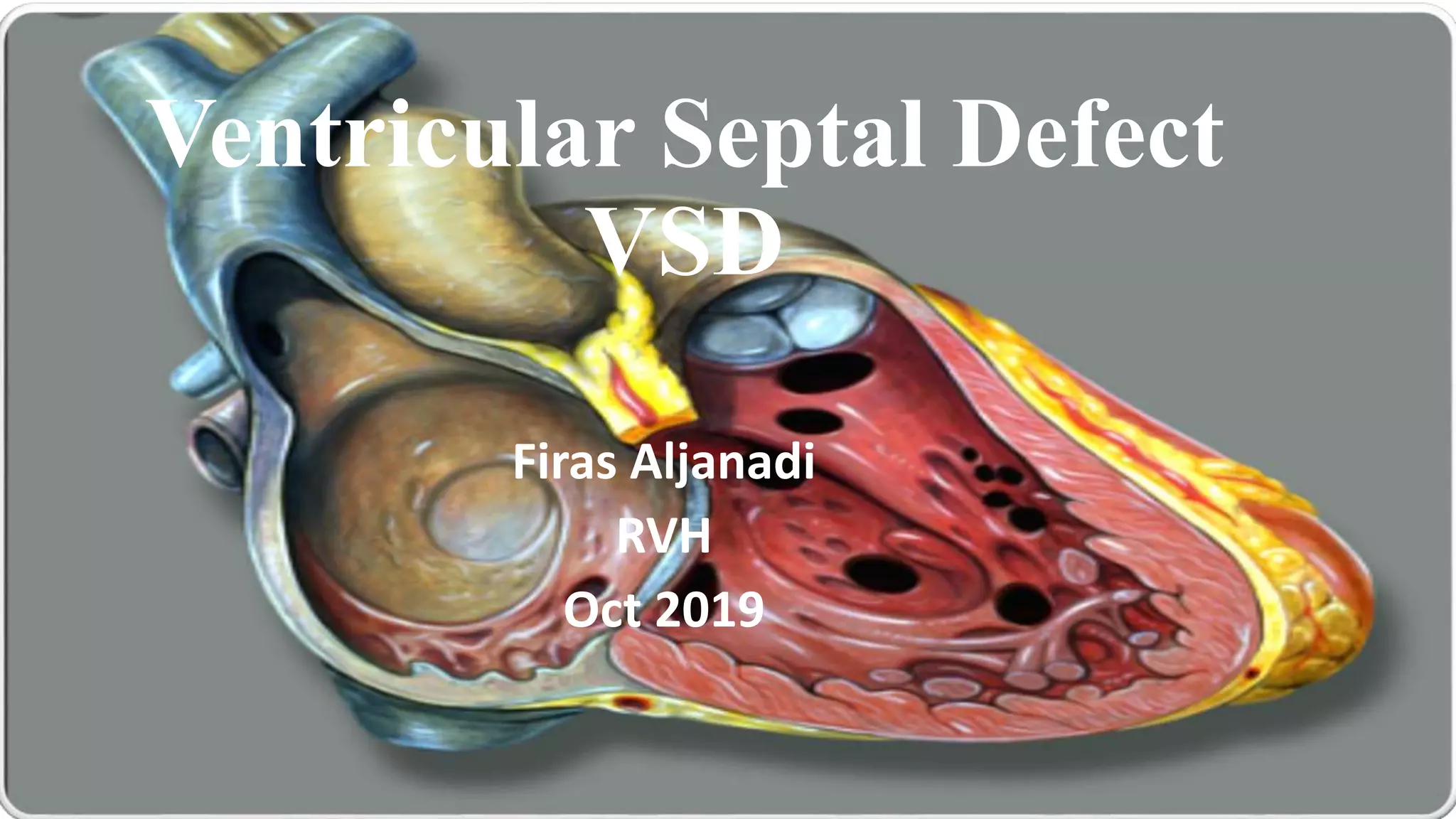 Ventricular septal defect VSD | PPT