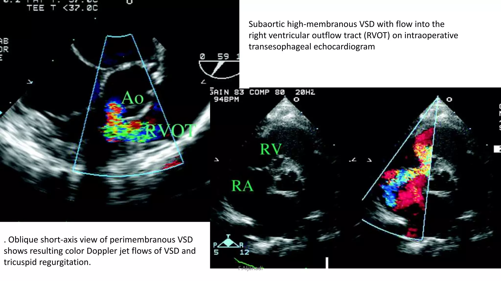Ventricular septal defect VSD | PPT