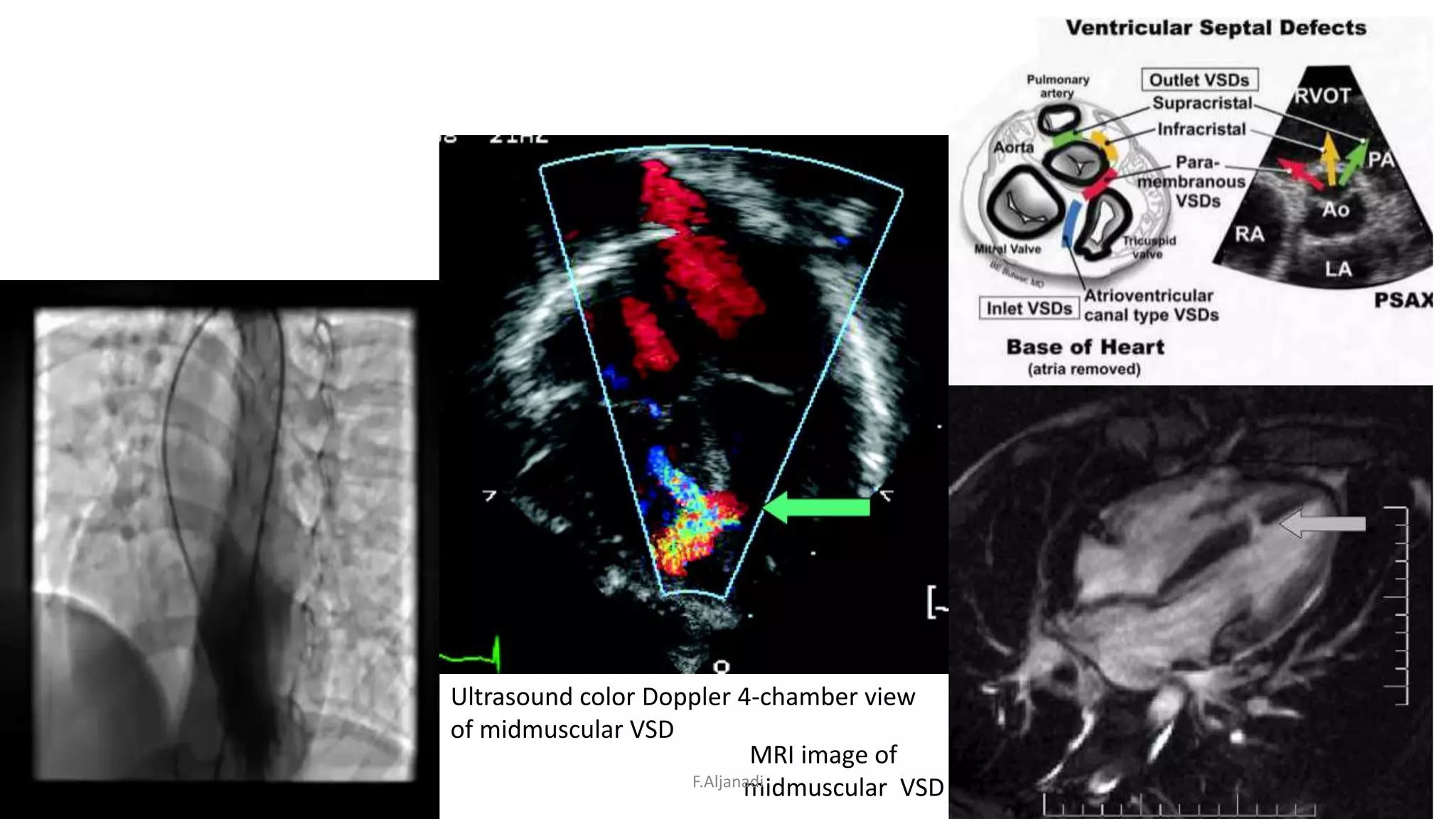 Ventricular septal defect VSD | PPT