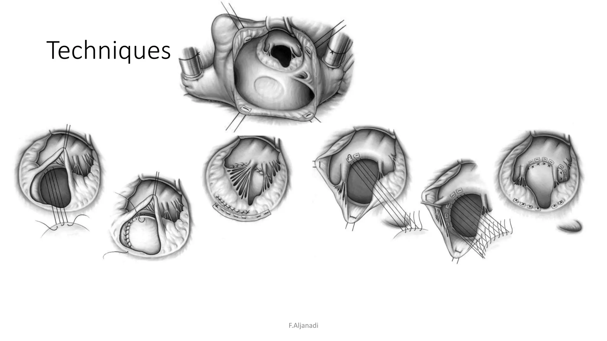 Ventricular septal defect VSD | PPT