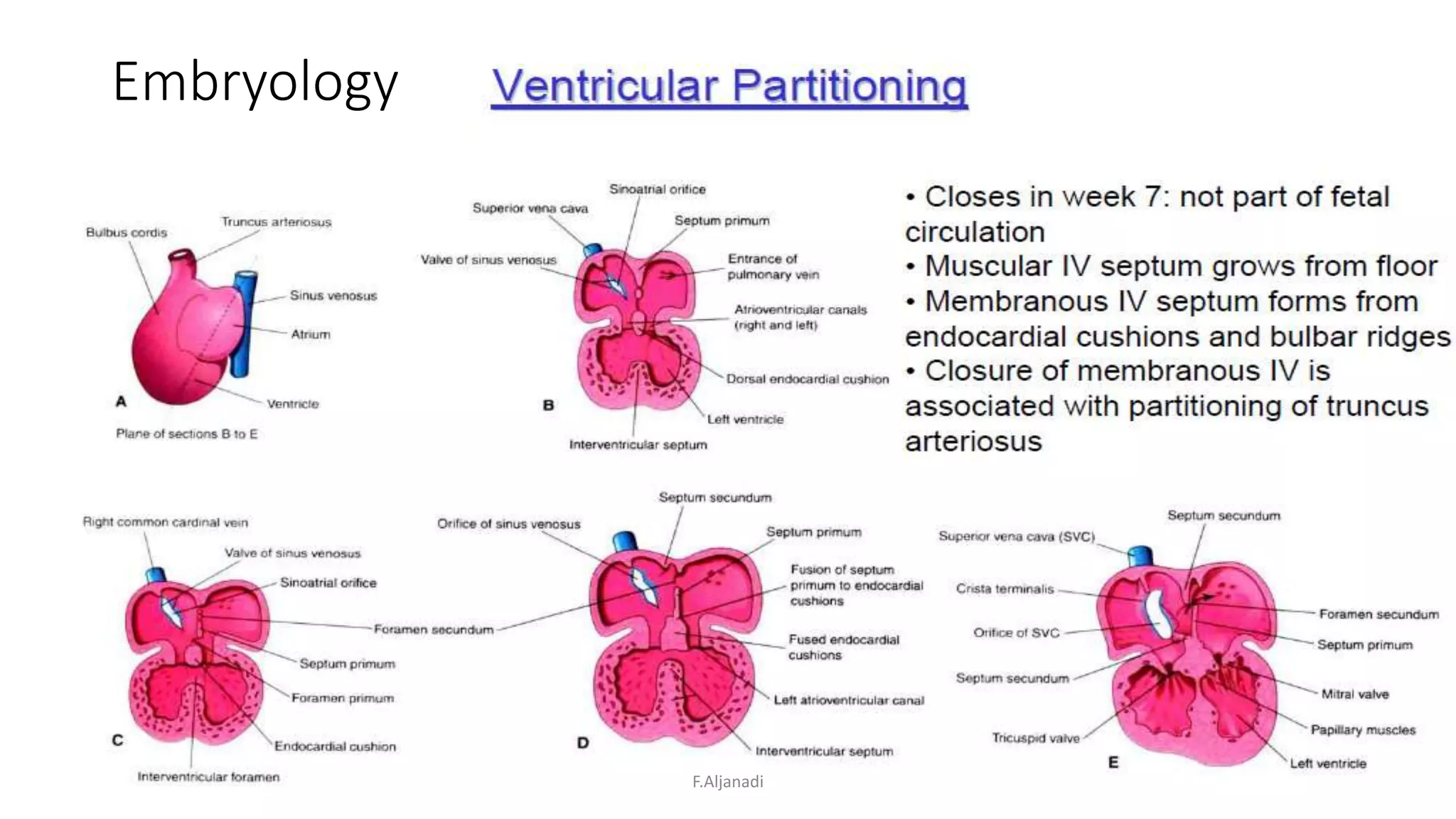 Ventricular septal defect VSD | PPT