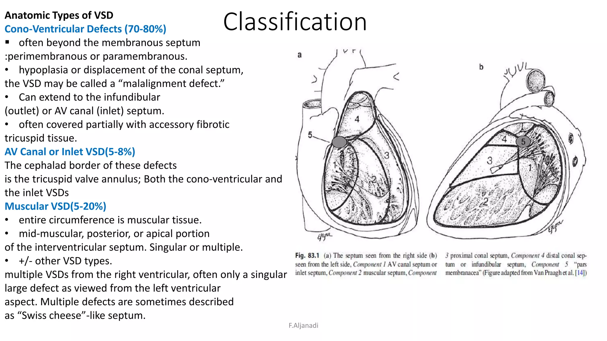 Ventricular septal defect VSD | PPT