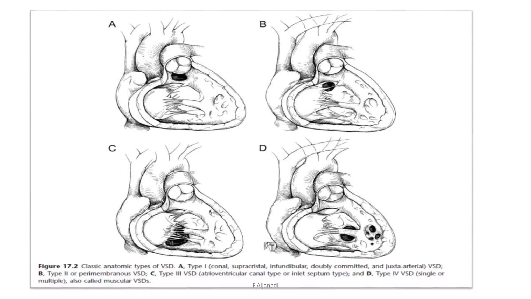 Ventricular septal defect VSD | PPT