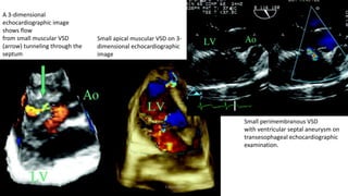 Ventricular septal defect VSD | PPT