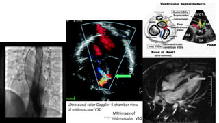 Ventricular septal defect VSD | PPT