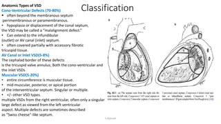 Ventricular septal defect VSD | PPT