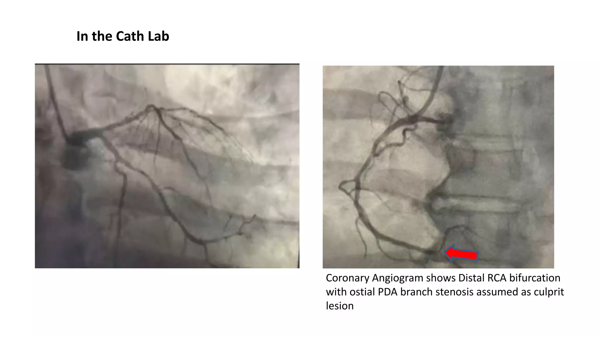 Ventricular septal rupture with cardiogenic shock follows by Inferior ...