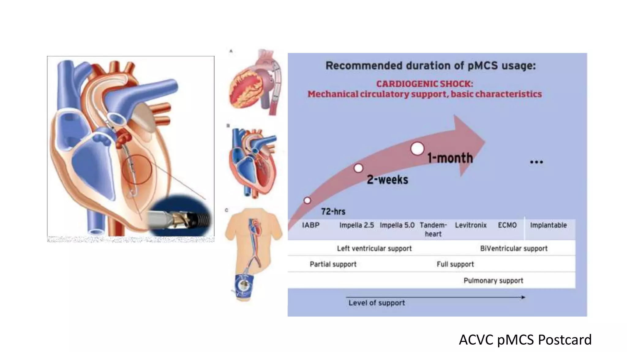 Ventricular septal rupture with cardiogenic shock follows by Inferior ...