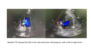 Ventricular septal rupture with cardiogenic shock follows by Inferior ...