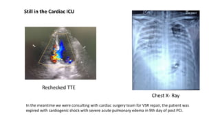 Ventricular septal rupture with cardiogenic shock follows by Inferior ...