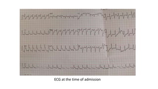 Ventricular septal rupture with cardiogenic shock follows by Inferior ...