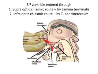 Ventricular system of the brain and its relation | PPT