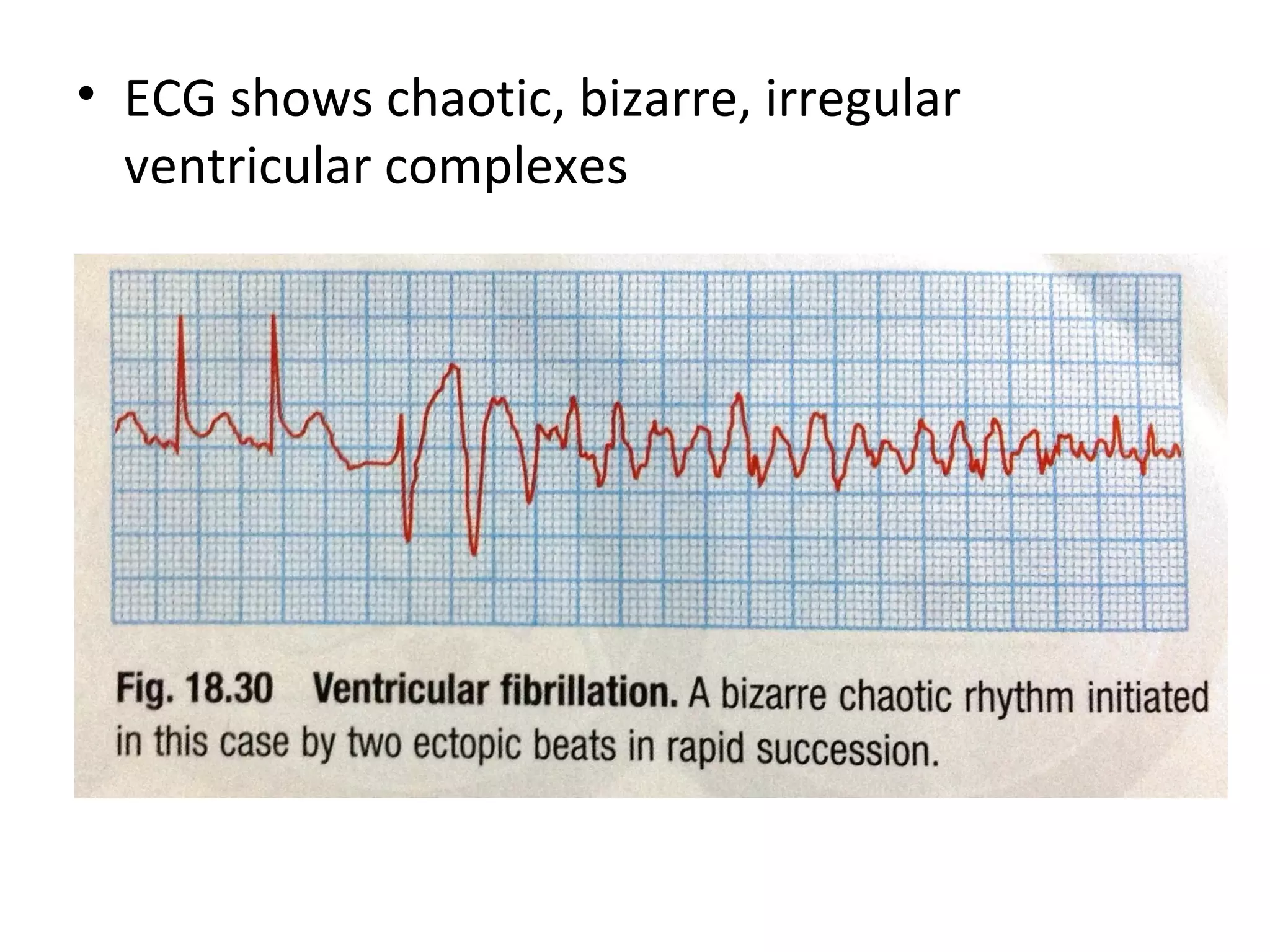 Ventricular tachyarrhythmias | PPT
