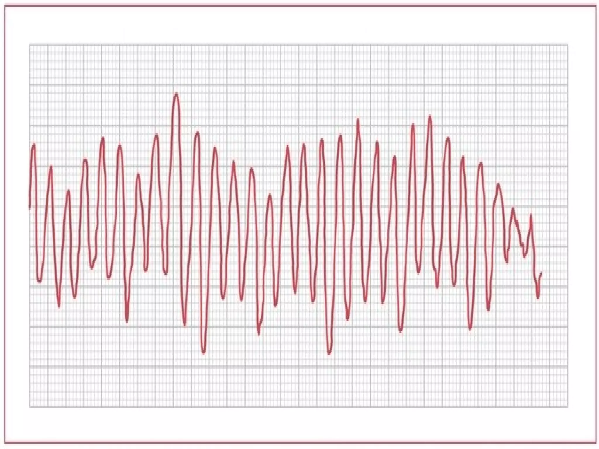 Ventricular tachyarrhythmias | PPT
