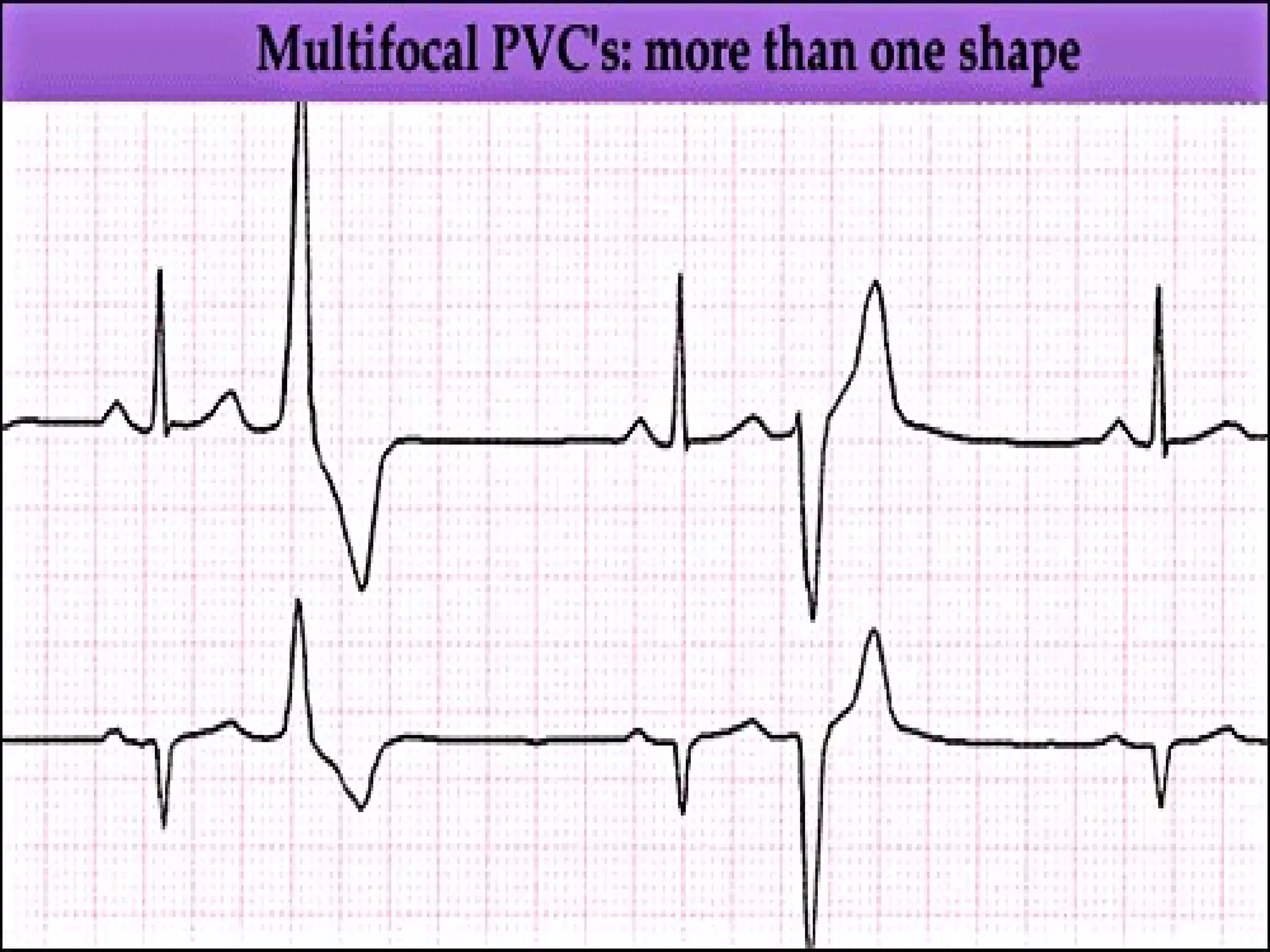 Ventricular tachyarrhythmias | PPT