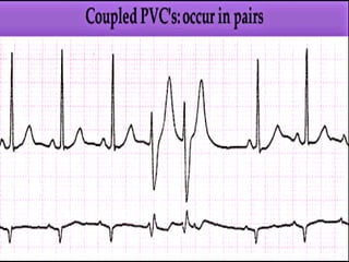Ventricular tachyarrhythmias | PPT