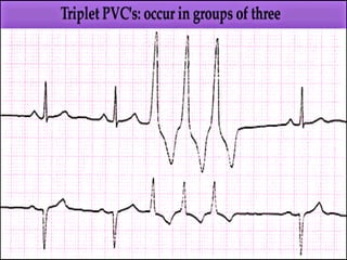 Ventricular tachyarrhythmias | PPT