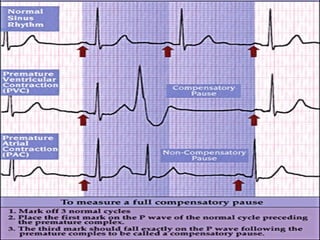 Ventricular tachyarrhythmias | PPT