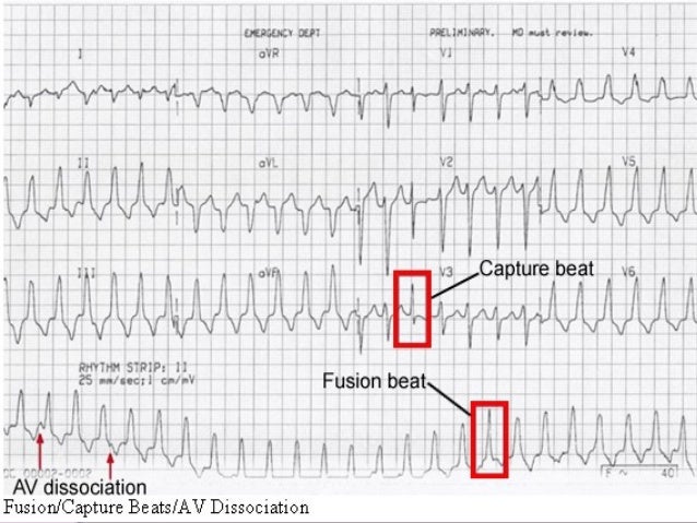 Ventricular tachyarrhythmias