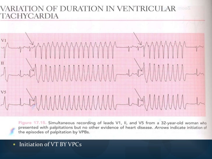 Ventricular tachycardia