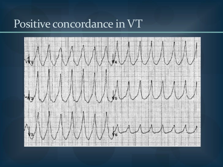 Ventricular tachycardia