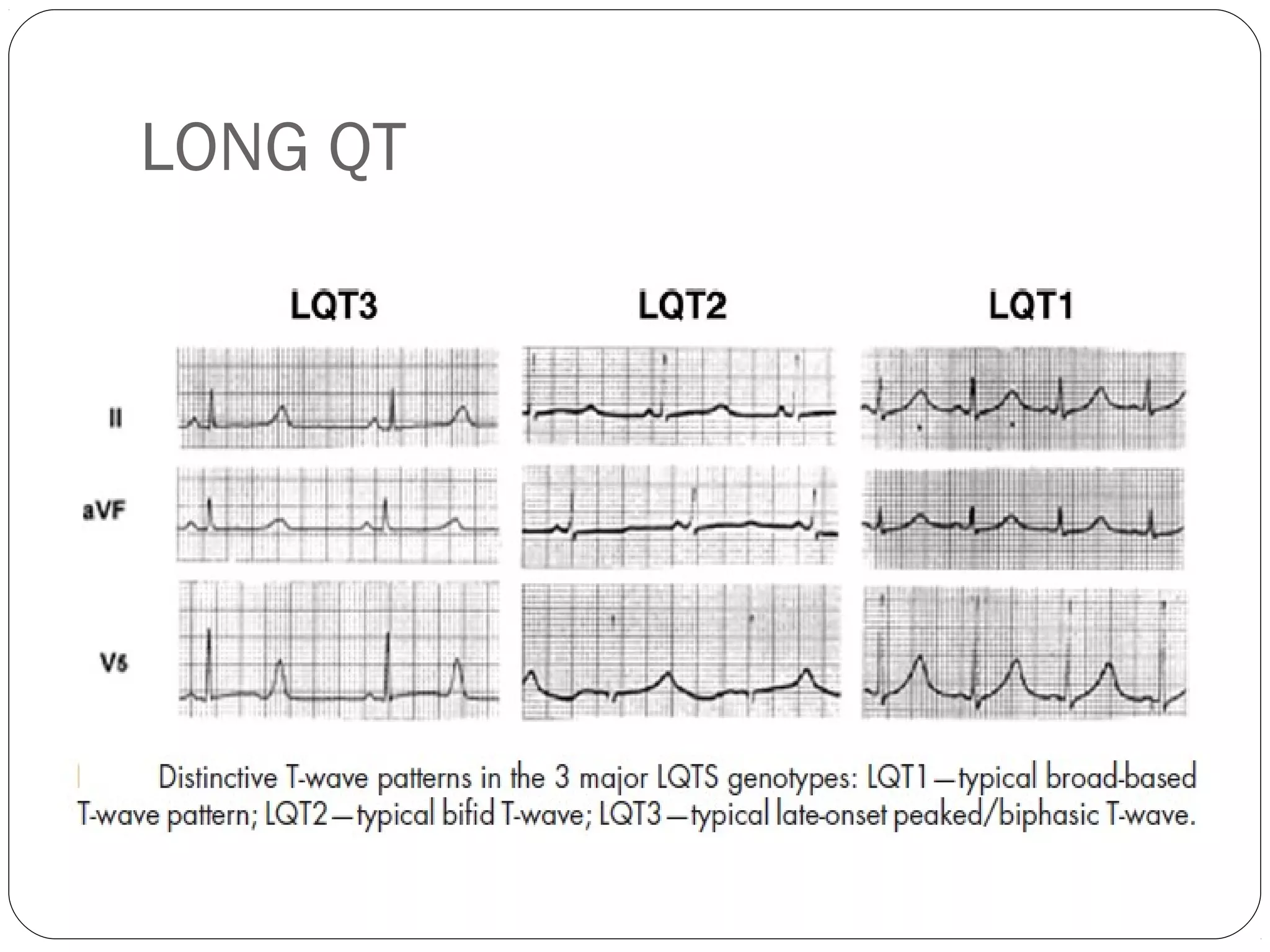 Ventricular tachycardia | PPT | Heart and Cardiovascular Diseases ...