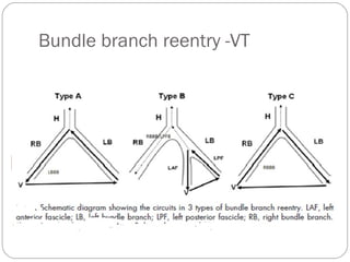Ventricular tachycardia | PPT