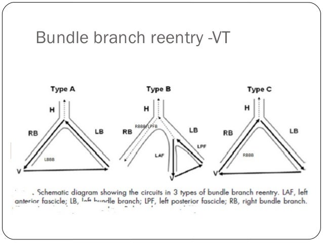 Ventricular tachycardia