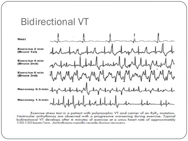 Ventricular tachycardia