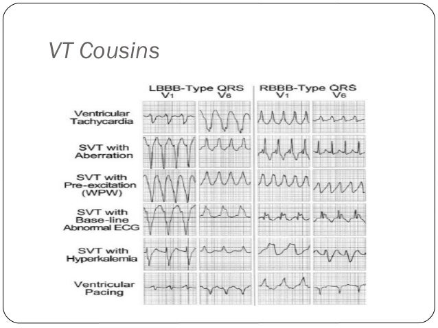 Ventricular tachycardia