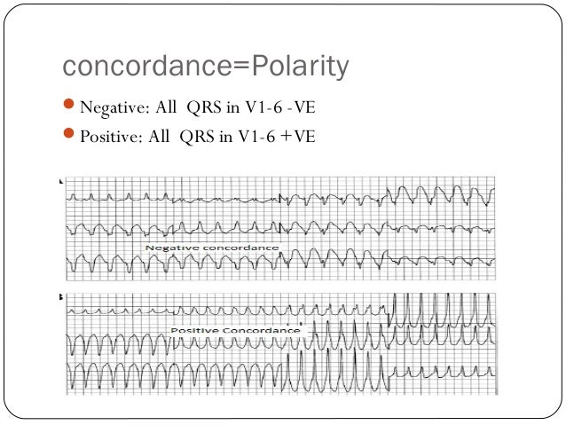 Ventricular tachycardia
