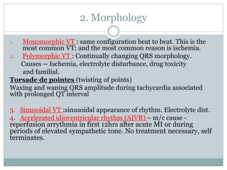 Ventricular tachycardia | PPT