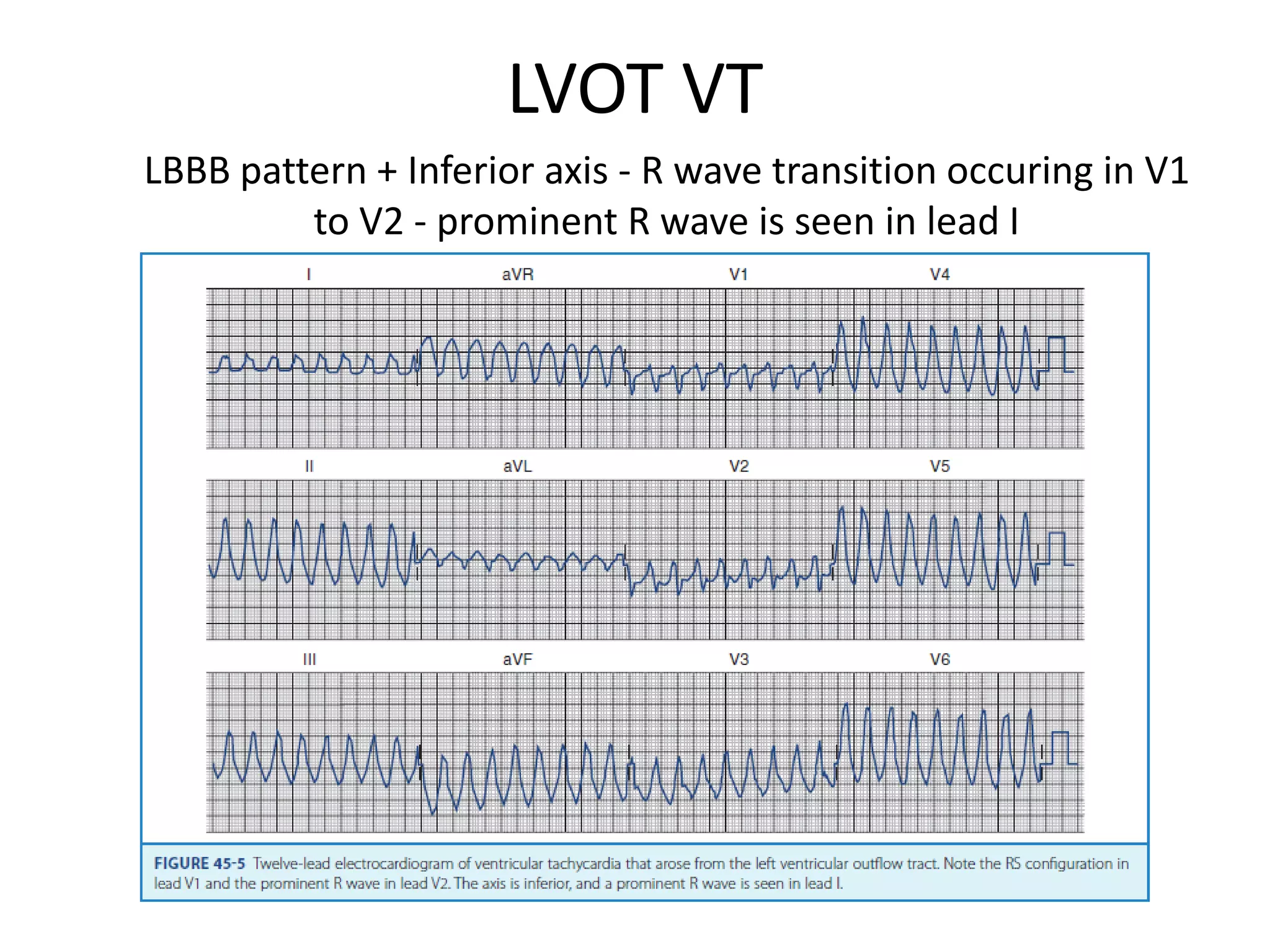 Ventricular tachycardia | PPTX
