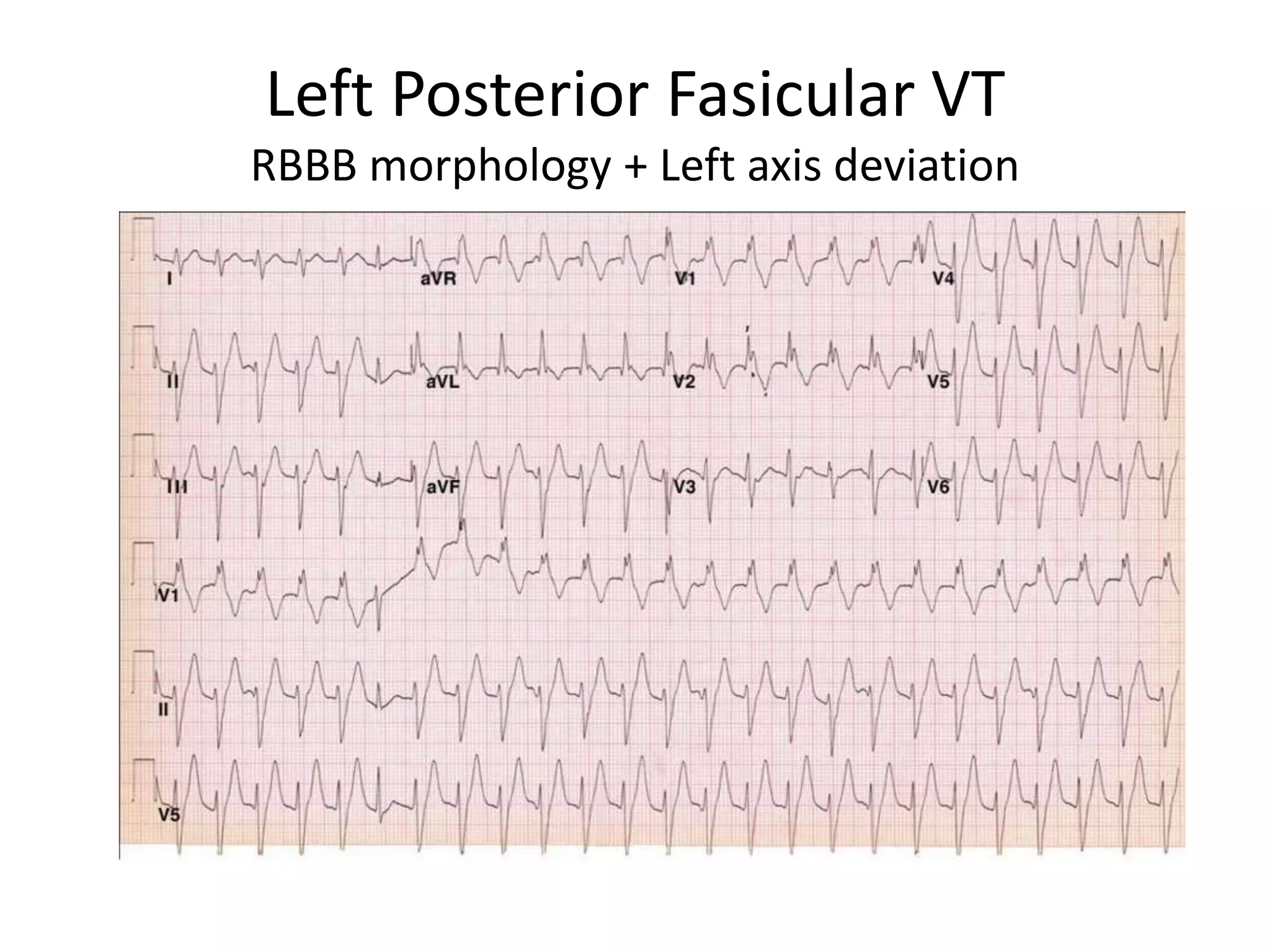 Ventricular tachycardia | PPTX