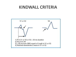 Ventricular tachycardia | PPTX