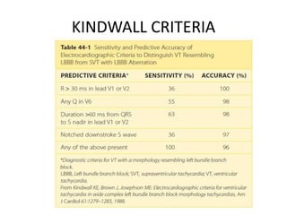 Ventricular tachycardia | PPTX